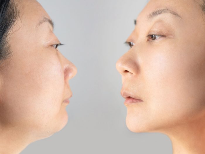 How SMAS Facelift Can Turn Back the Clock - Amber Beila Beauty Pte Ltd