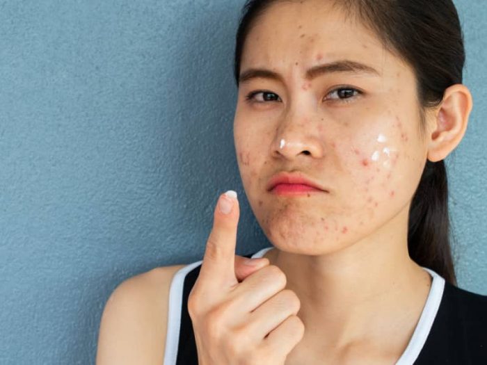 Amber Beila Beauty Pte Ltd | Acne SOS: Tackling Facial, Chest, and Back ...